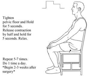 Post Prostatectomy Excercises - Urology San Antonio